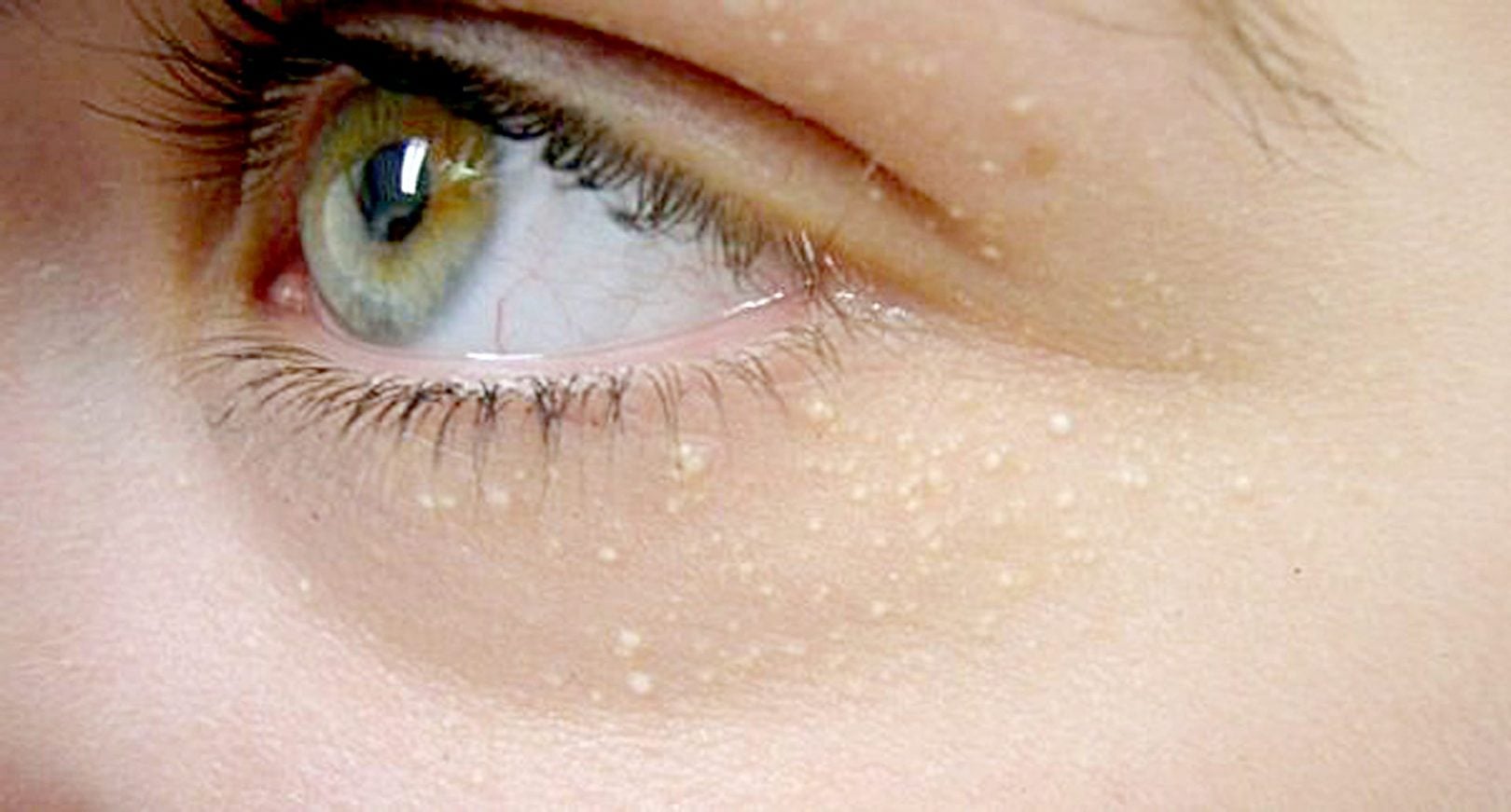 Xantelasmas Palpebrales